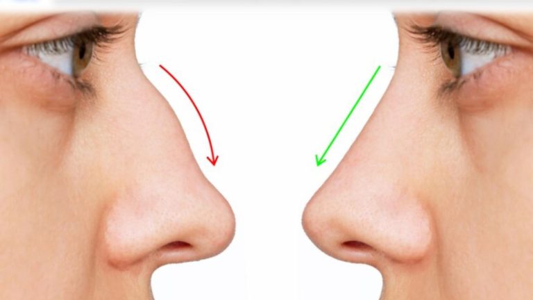 Understanding the Aquiline Nose: Features and Significance - Tumgazeteler